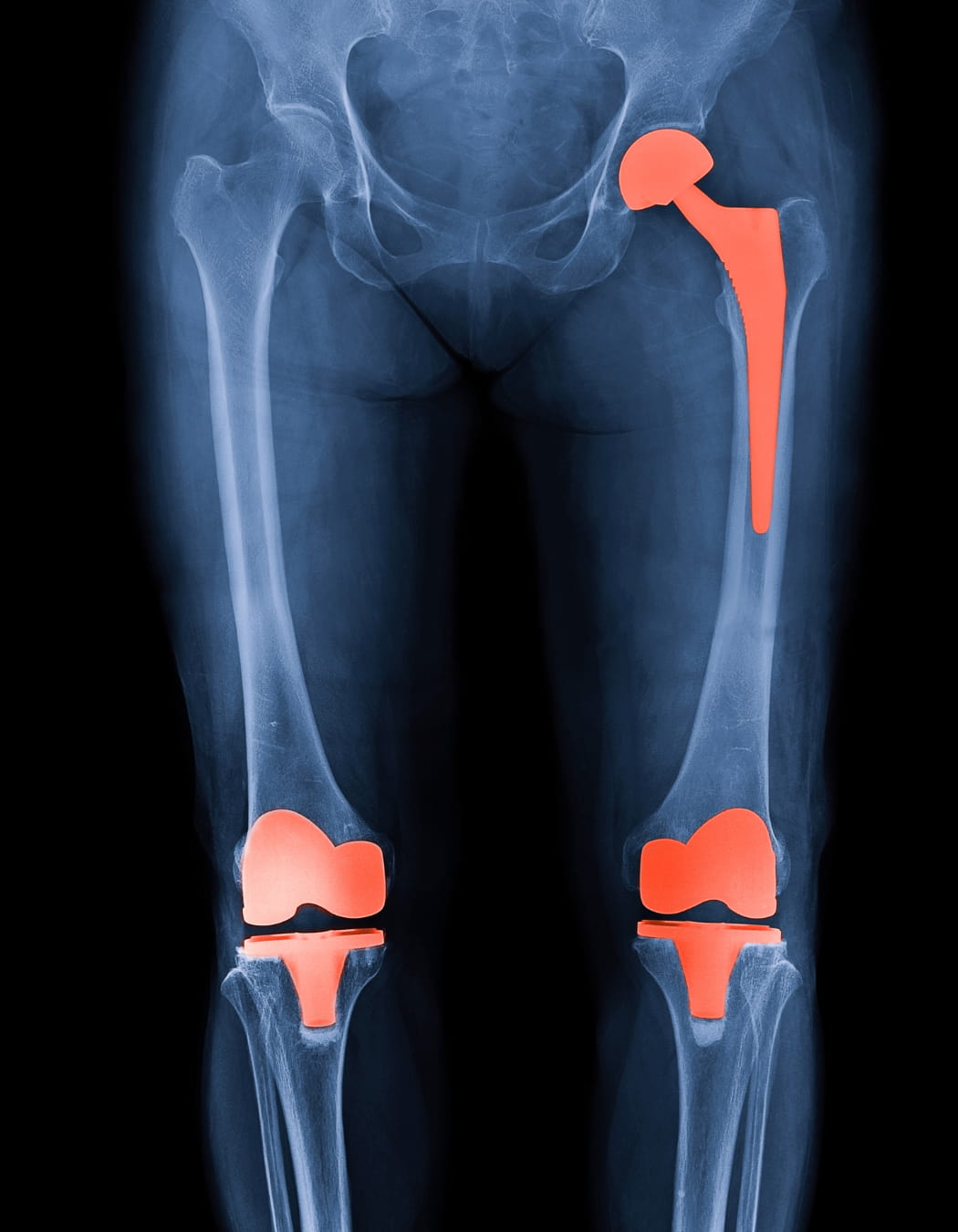 Understanding Knee Pain After Hip Replacement Surgery