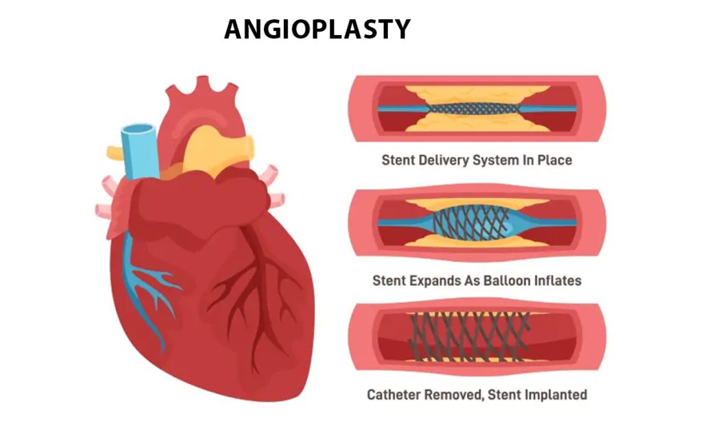 Angiogram vs Angioplasty: Understanding the Key Differences