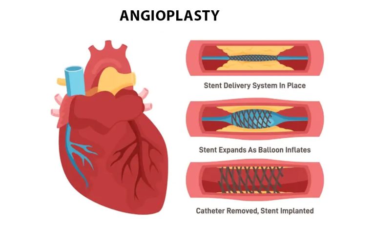 Angiogram vs Angioplasty: Understanding the Key Differences