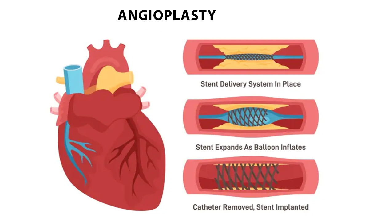 Angiogram vs Angioplasty: Understanding the Key Differences